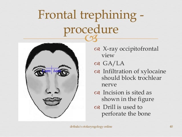 External approaches to sinus surgery
