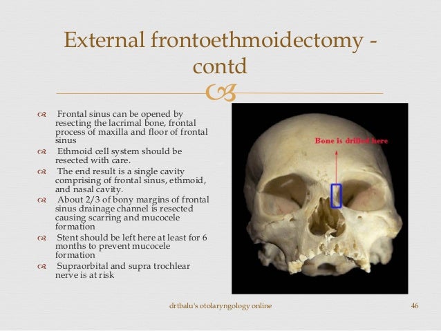 External approaches to sinus surgery
