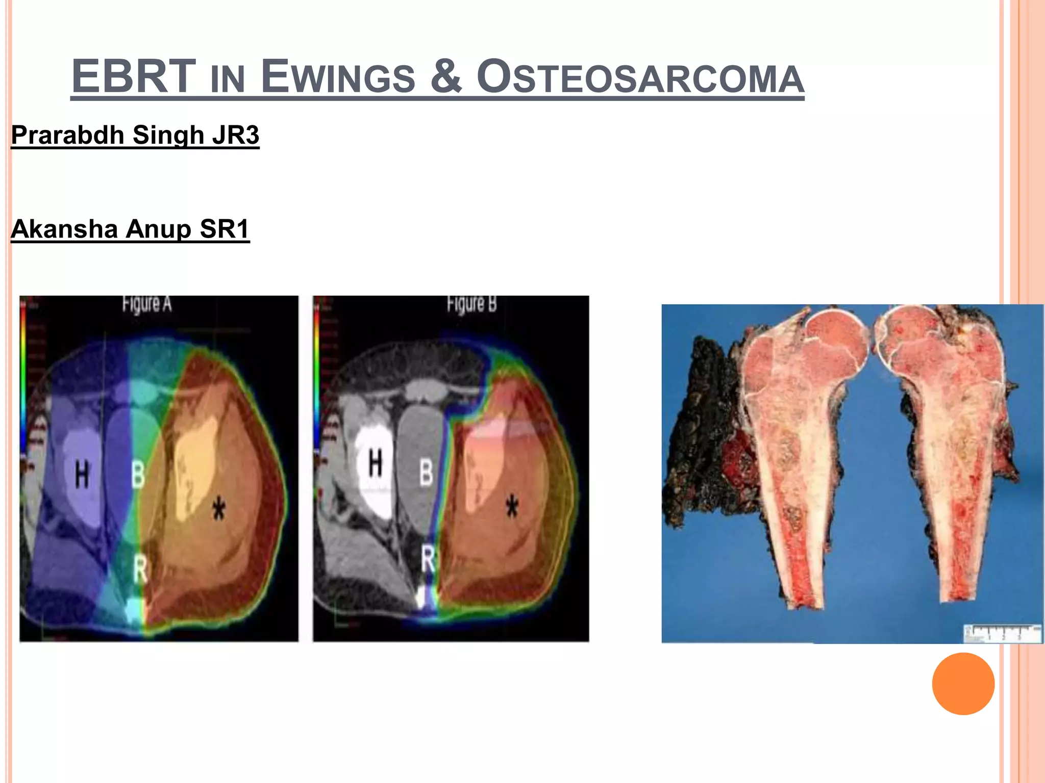 Management of ewings sarcoma & osteosarcoma | PPT