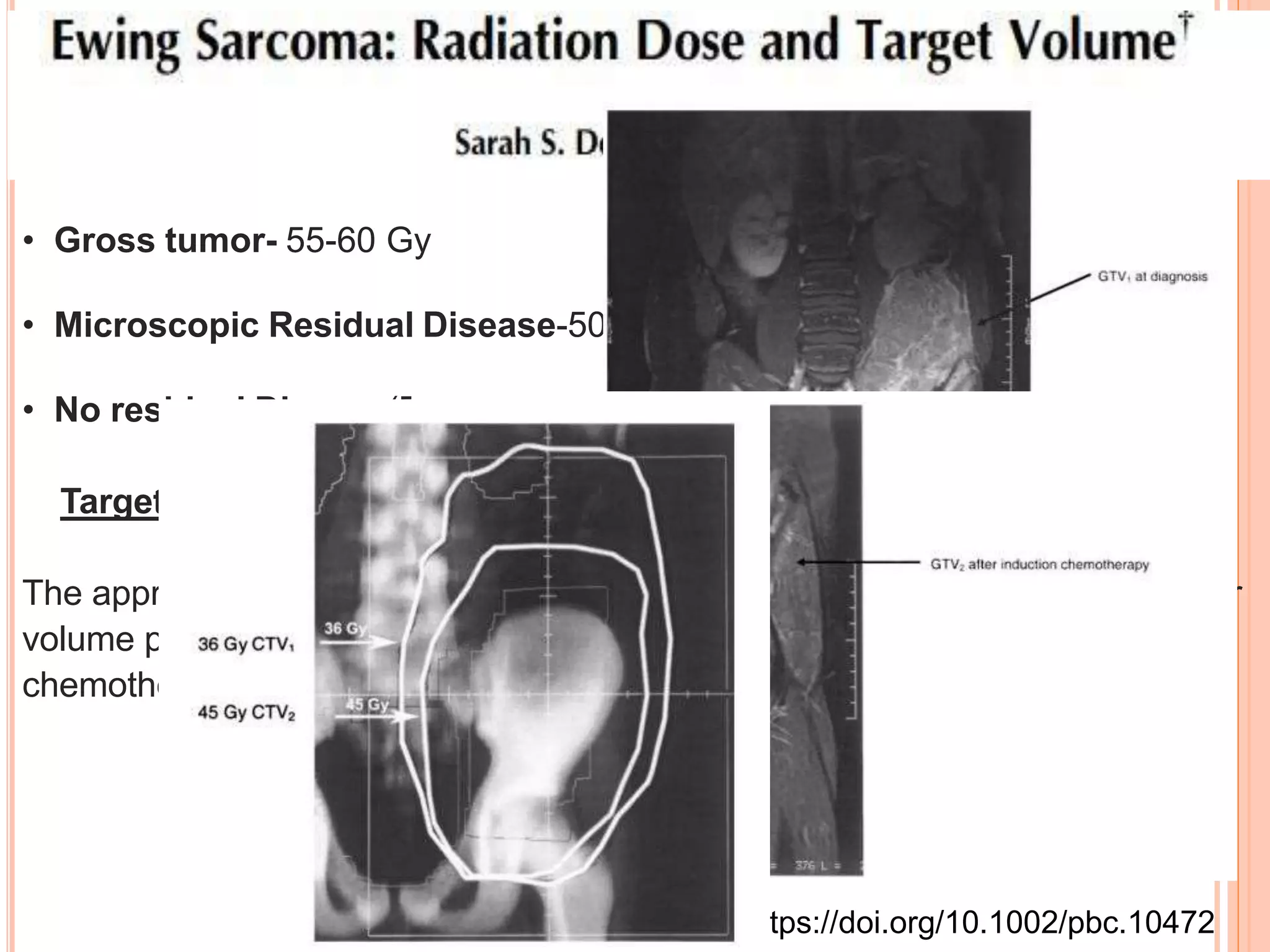 Management of ewings sarcoma & osteosarcoma | PPT