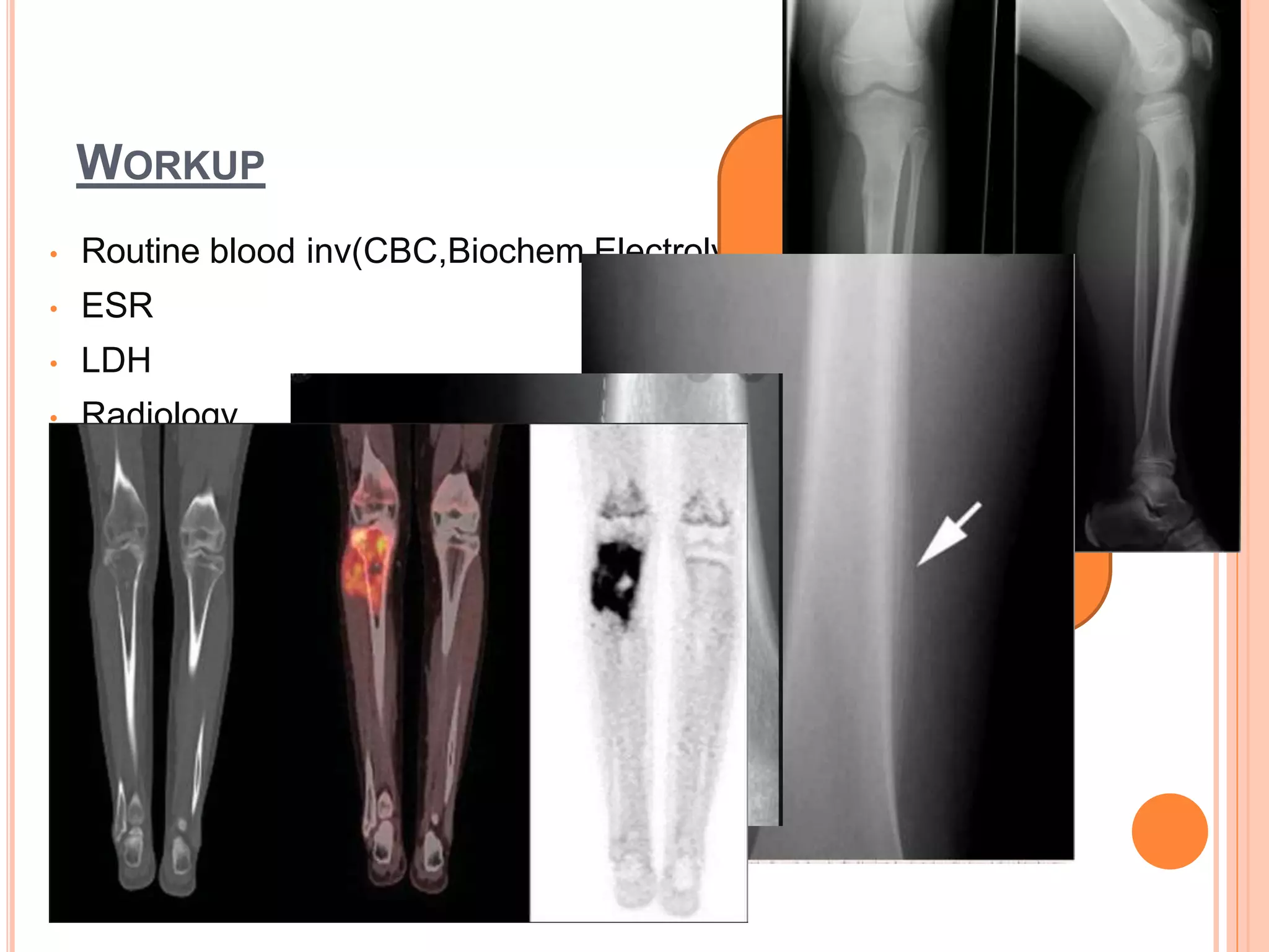 Management of ewings sarcoma & osteosarcoma | PPT