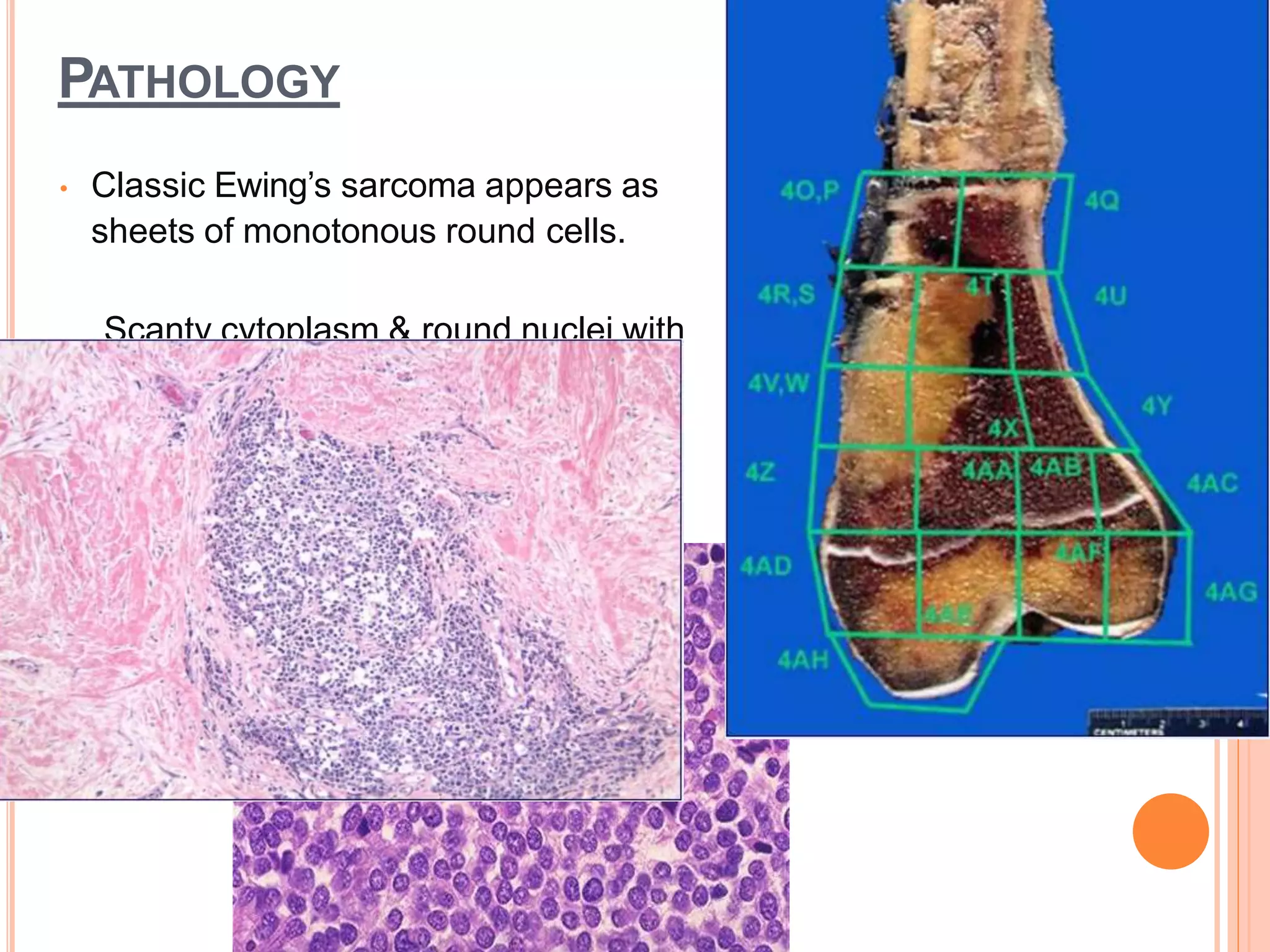 Management of ewings sarcoma & osteosarcoma | PPT