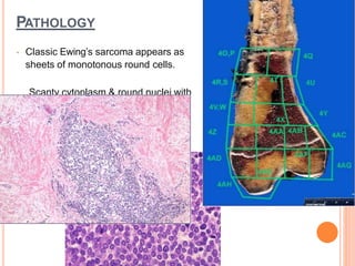 Management of ewings sarcoma & osteosarcoma | PPTX