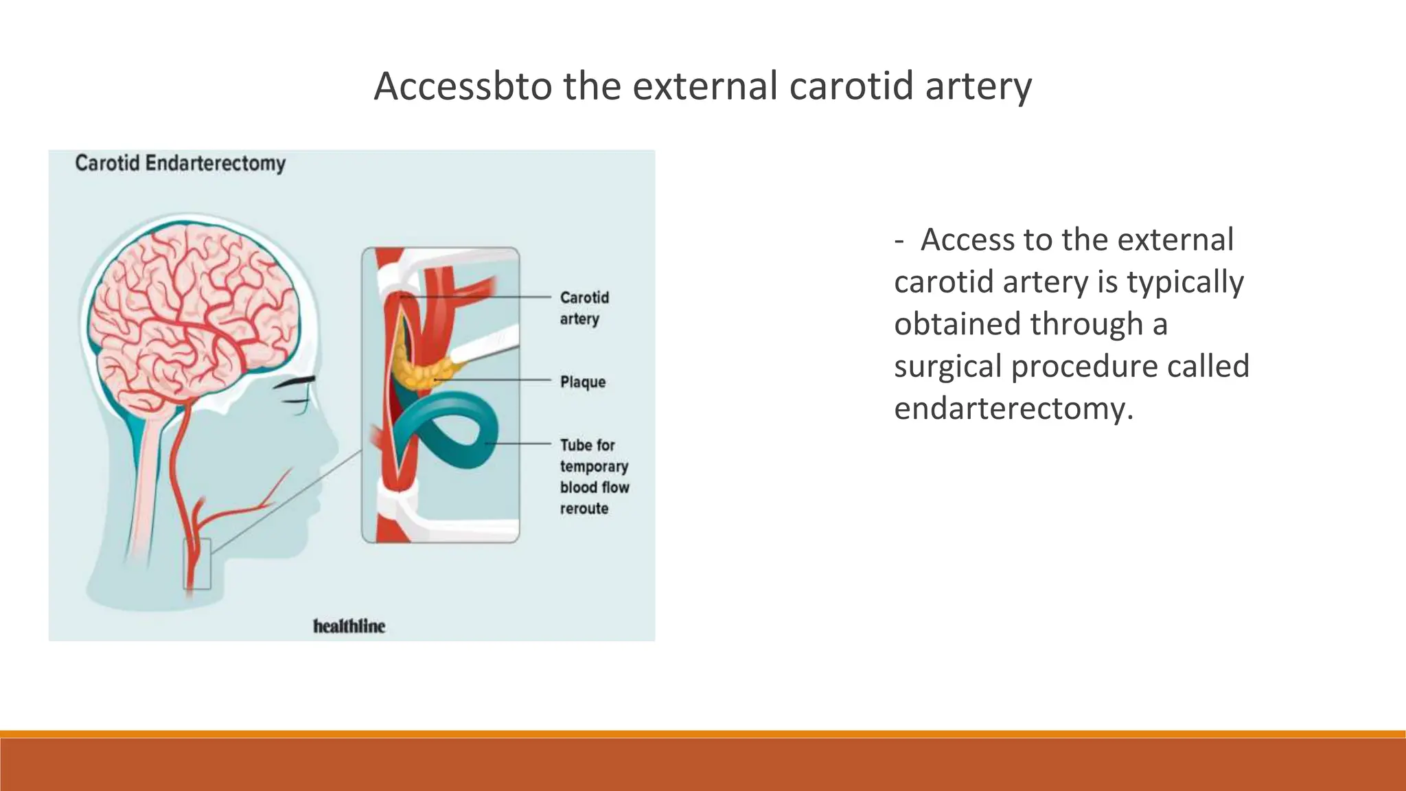 External carotid artery , ligation of External carotid artery, lingual ...