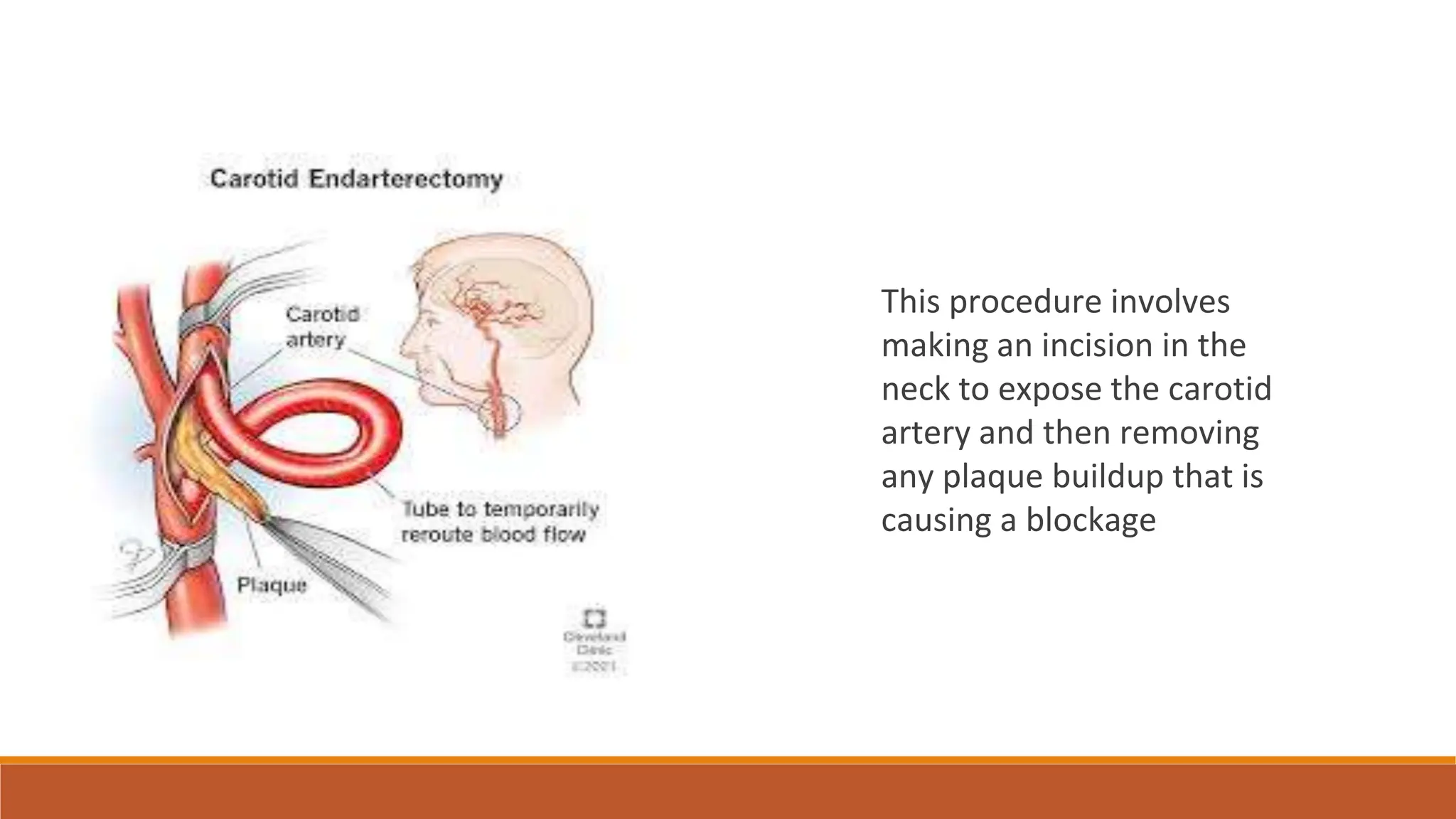 External carotid artery , ligation of External carotid artery, lingual ...