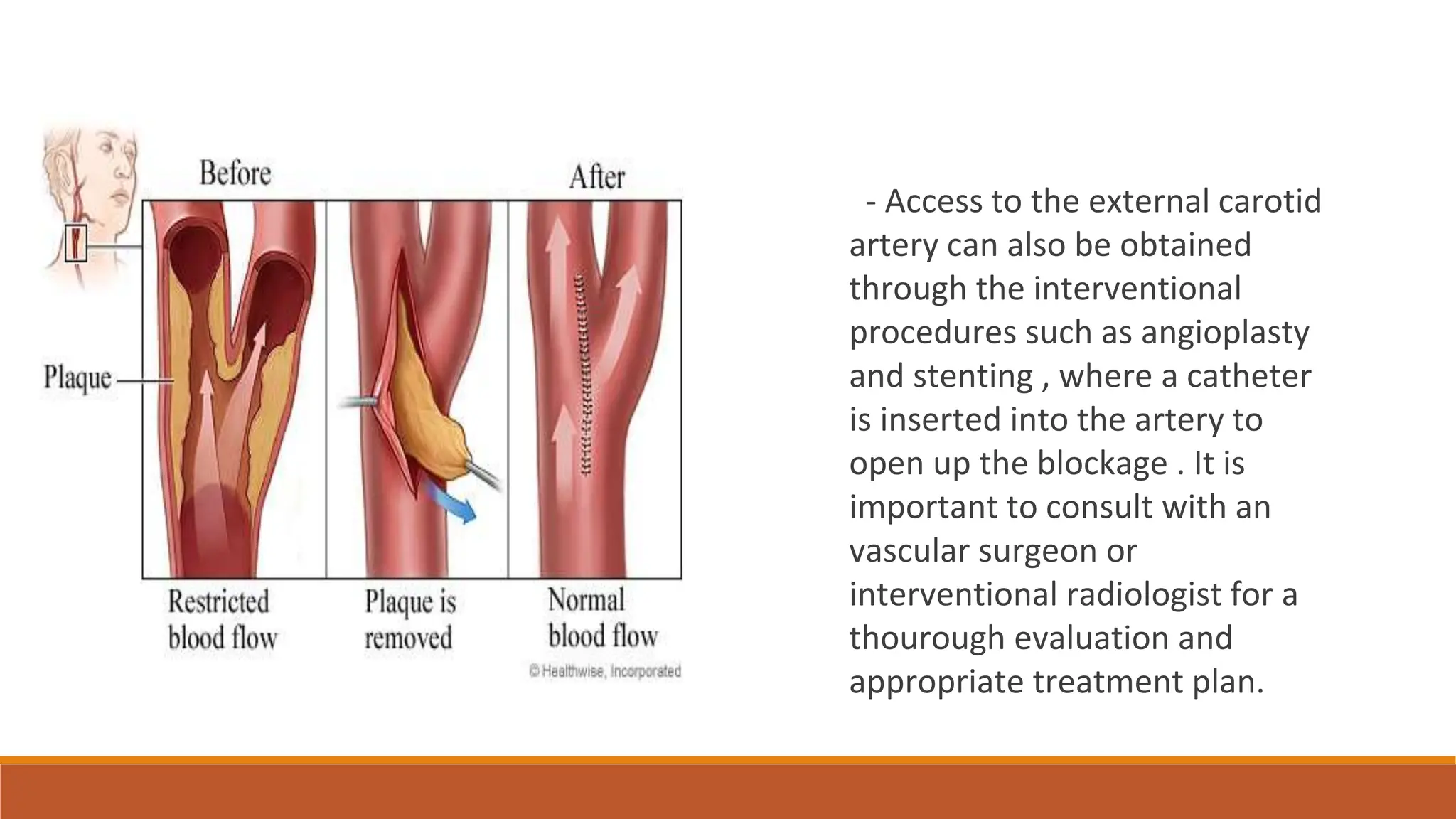 External carotid artery , ligation of External carotid artery, lingual ...
