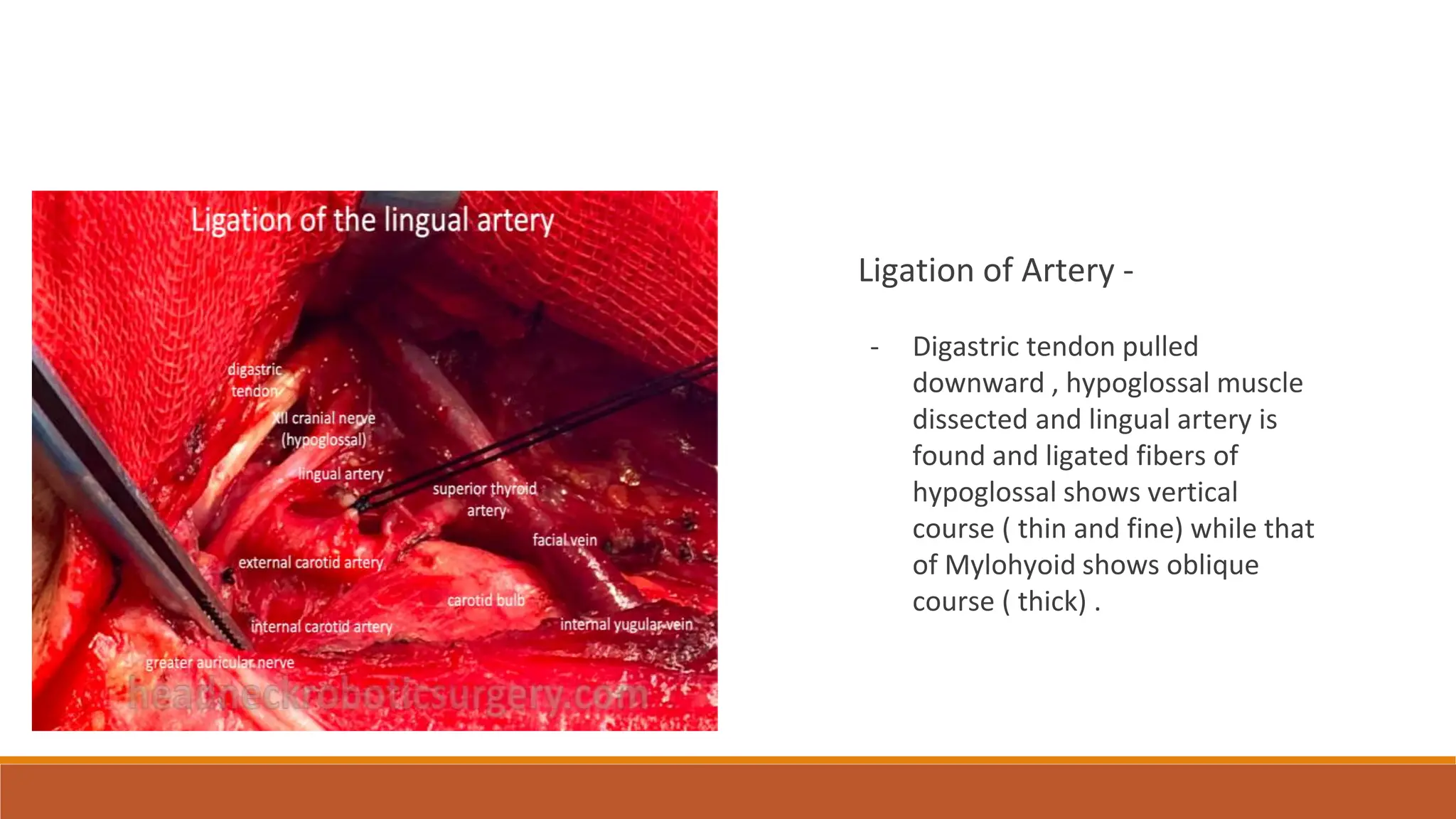 External carotid artery , ligation of External carotid artery, lingual ...