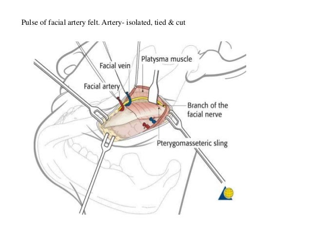 External carotid artery, branches and ligation