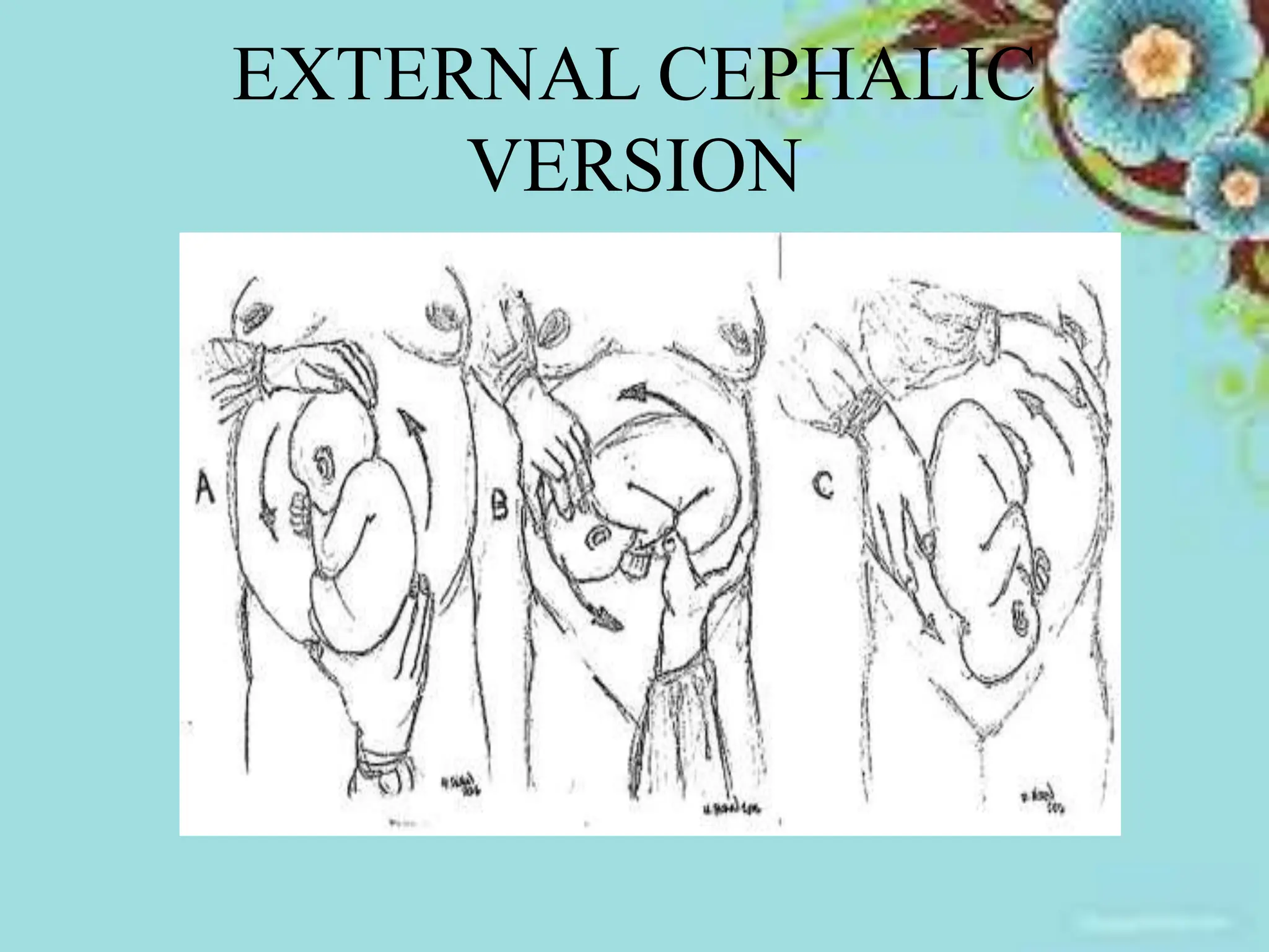 EXTERNAL CEPHALIC VERSION OBG NOTES .pptx | Pregnancy | Reproductive Health