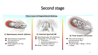 External_cephalic_version_and_Internal_podalic_version_for_Anst.ppt