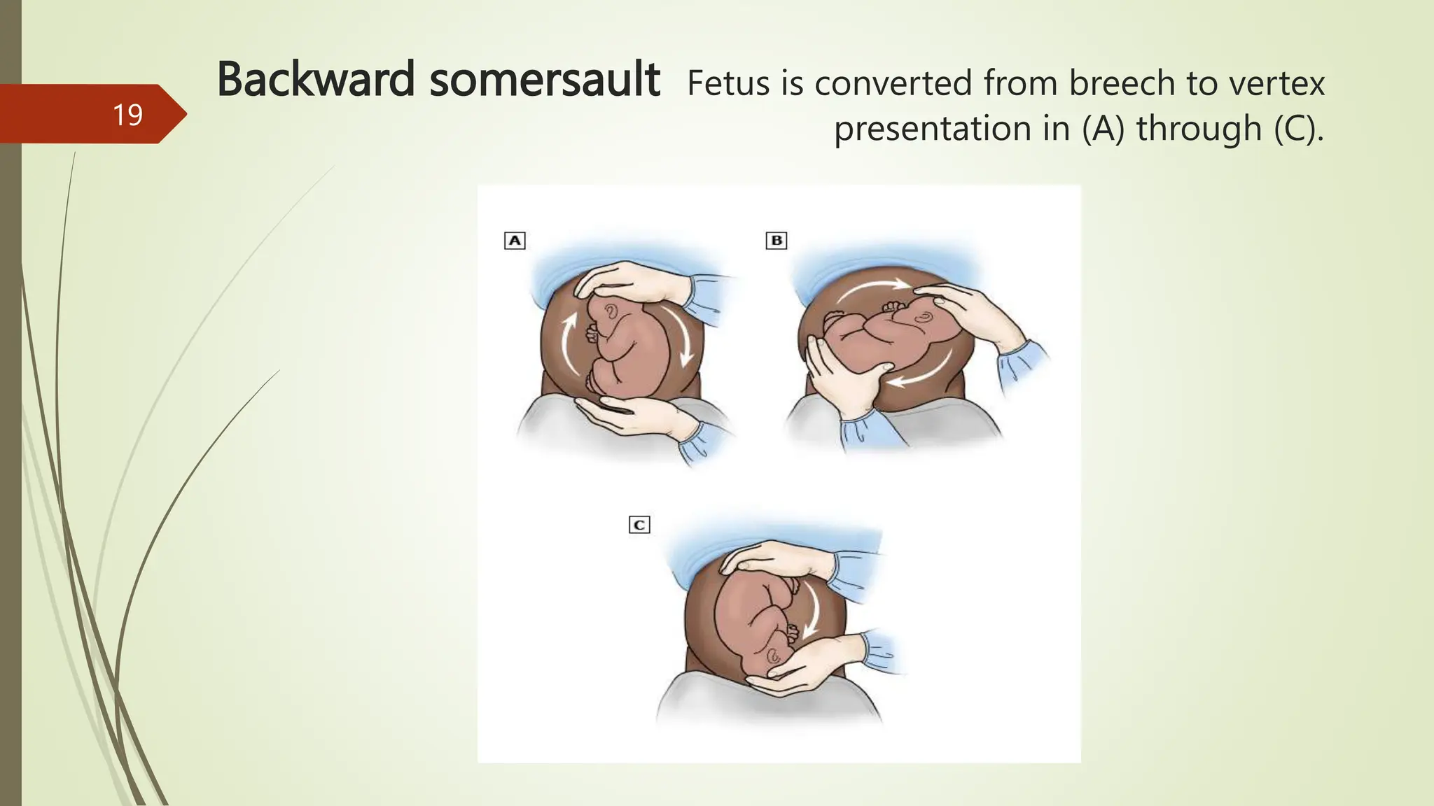 EXTERNAL CEPHALIC VERSION BY DR Alphonse.pptx