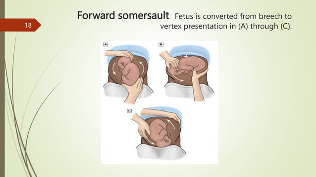 EXTERNAL CEPHALIC VERSION BY DR Alphonse.pptx | Pregnancy ...