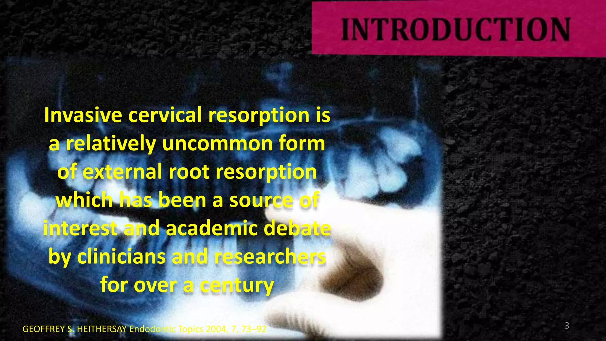 “Saving the borders” External cervical resorption : A Case report | PPTX