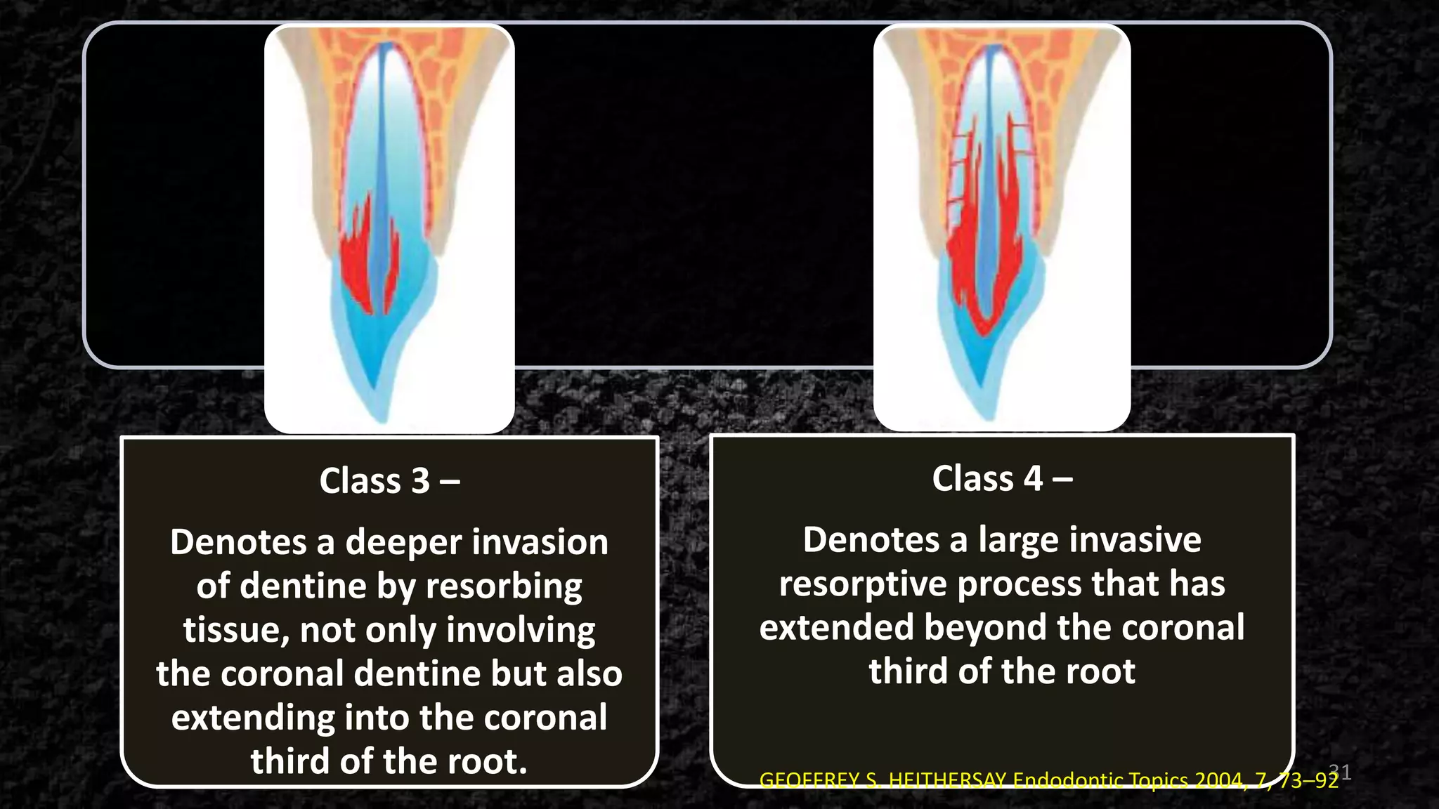“Saving the borders” External cervical resorption : A Case report | PPTX