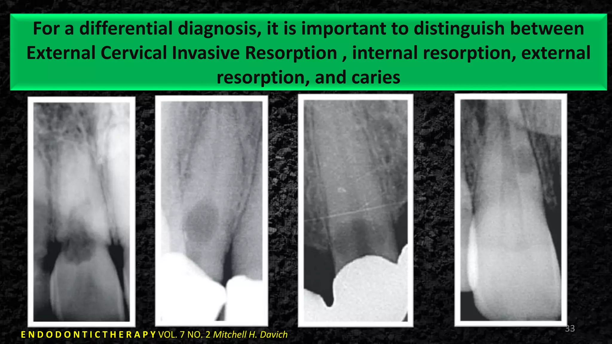 “Saving the borders” External cervical resorption : A Case report | PPTX