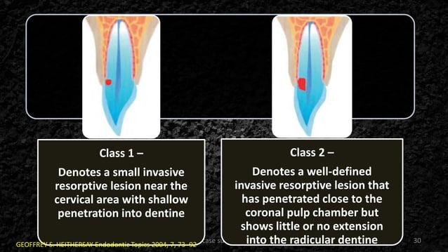 “Saving the borders” External cervical resorption : A Case report | PPT