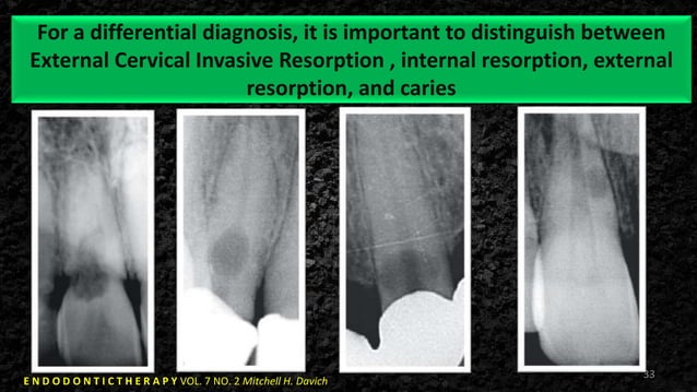 “Saving the borders” External cervical resorption : A Case report | PPT