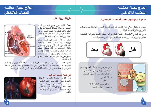 External counterpulsation therapy | PPT