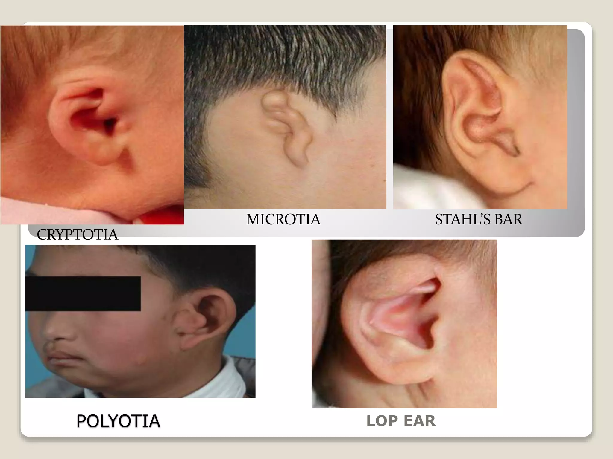 ANATOMY OF EXTERNAL EAR | PPTX