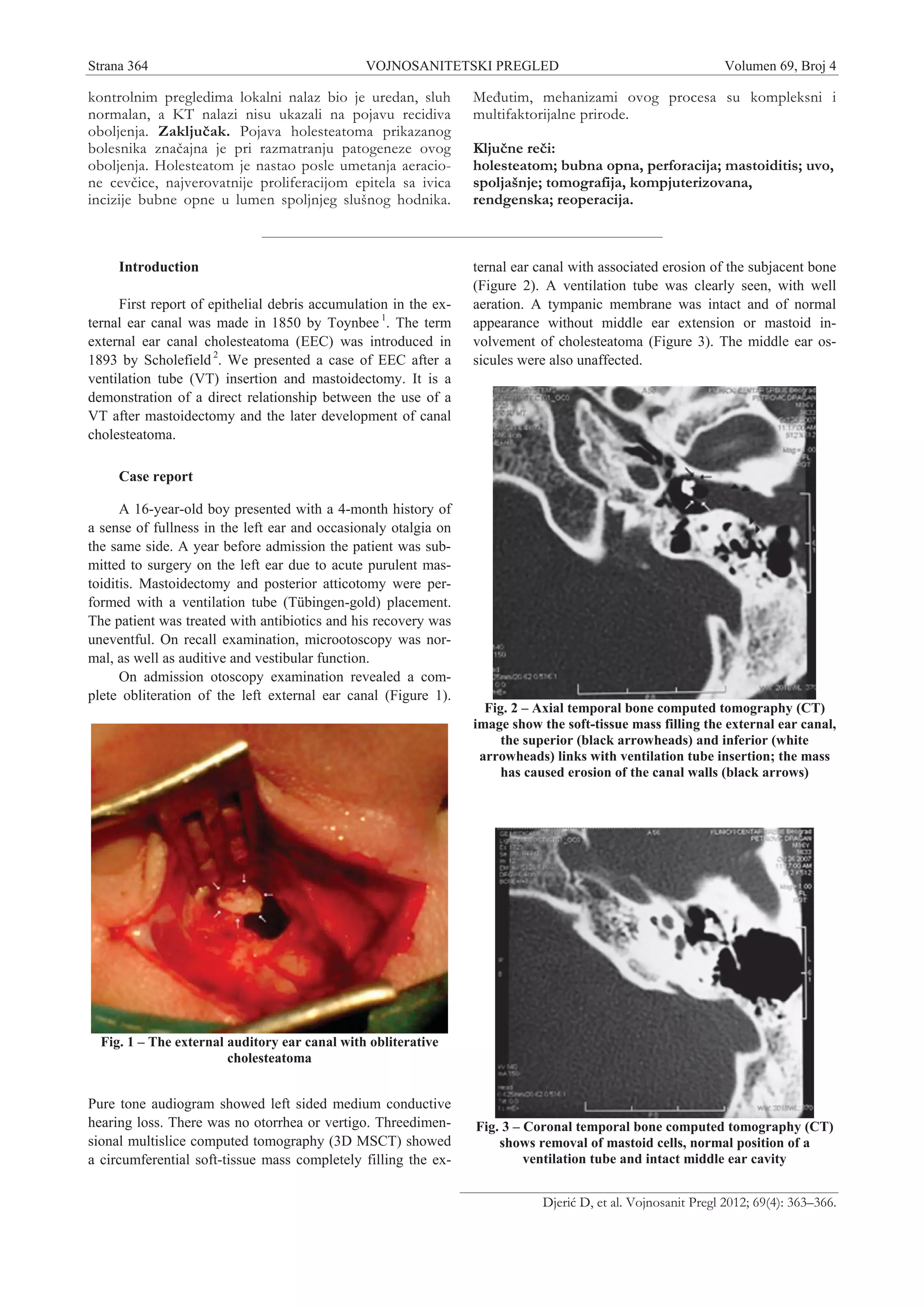 External ear canal cholesteatoma after ventilation tube insertion | PDF