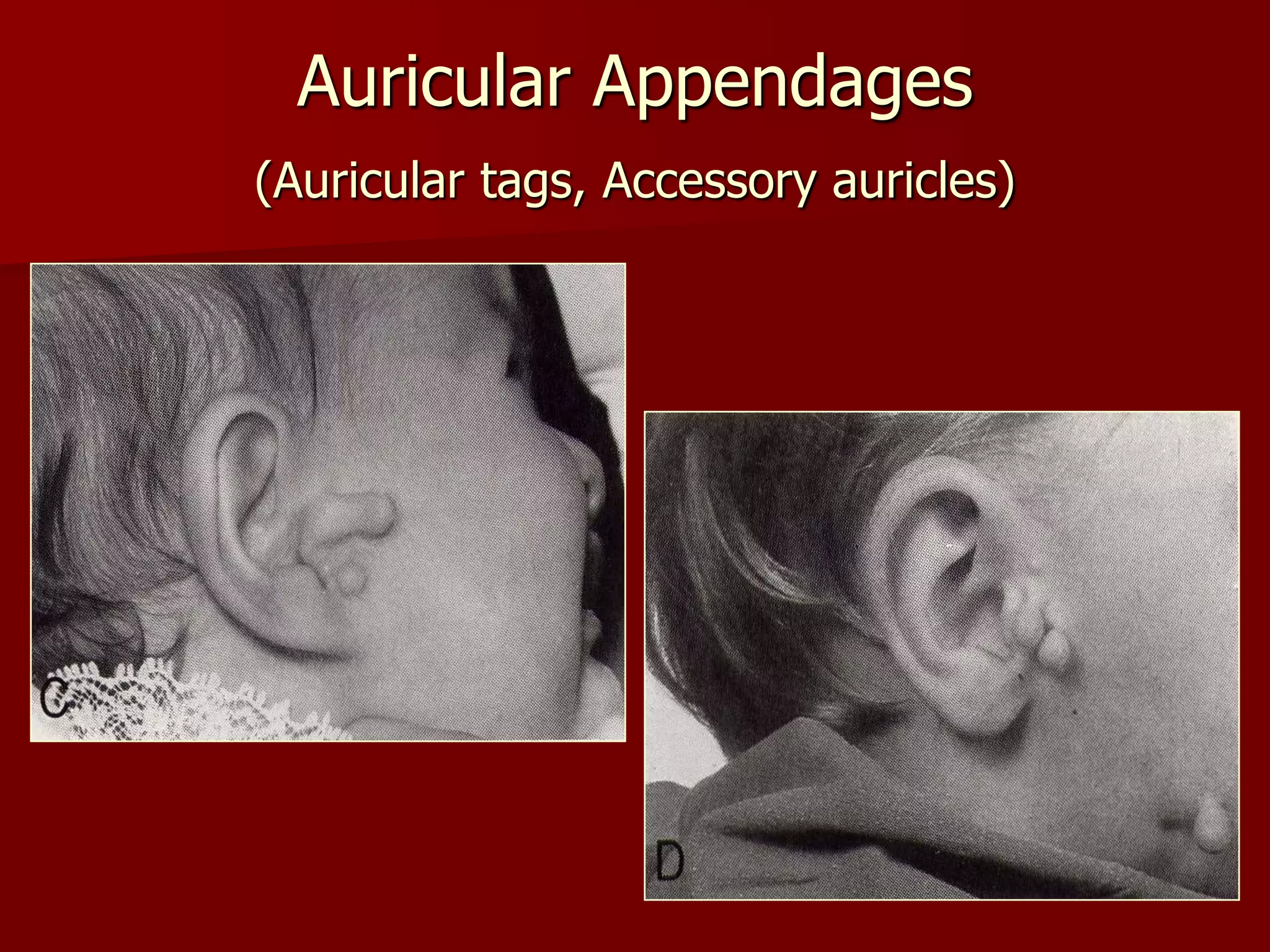Diseases of the External Ear | PPT