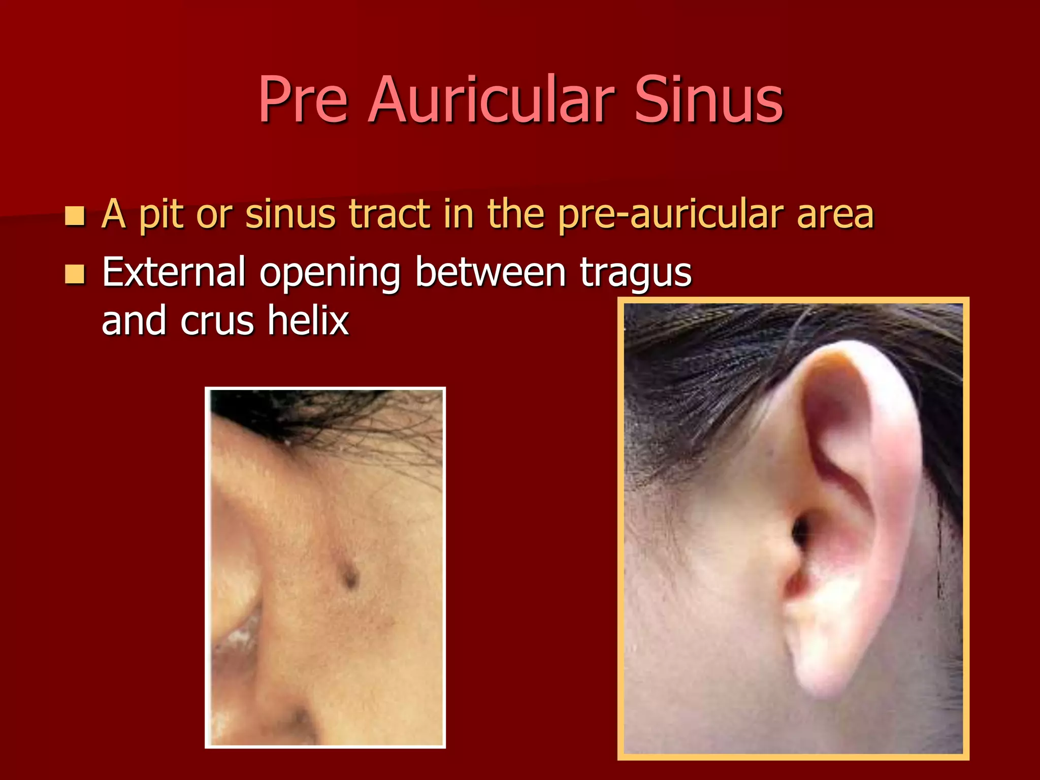 Diseases of the External Ear | PPT
