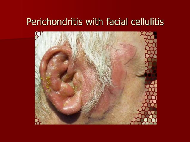 Diseases of the External Ear | PPT | Ear, Nose and Throat Conditions ...