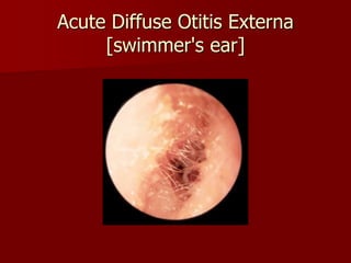Otitis Externa Otoscope