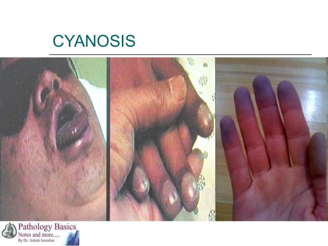 External examination at autopsy