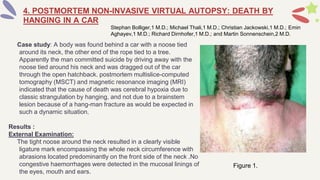 External examination in hanging cases.pptx