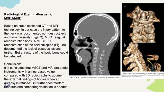 External examination in hanging cases.pptx