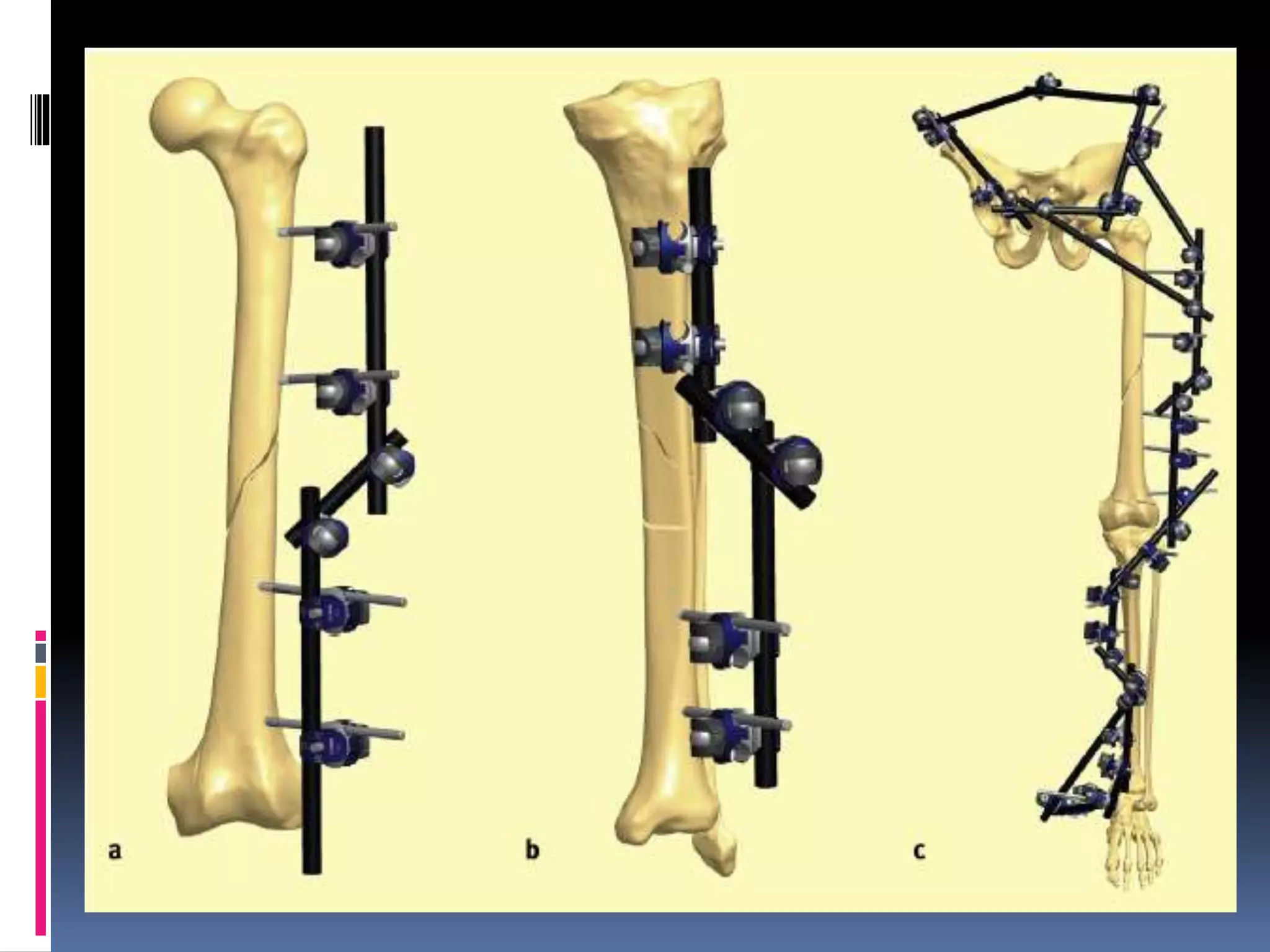principles of External fixation | PPTX