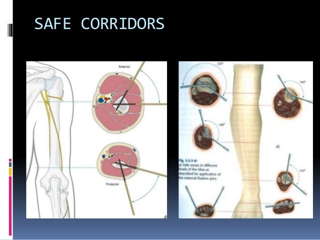 principles of External fixation