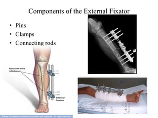 External Fixation.pptx