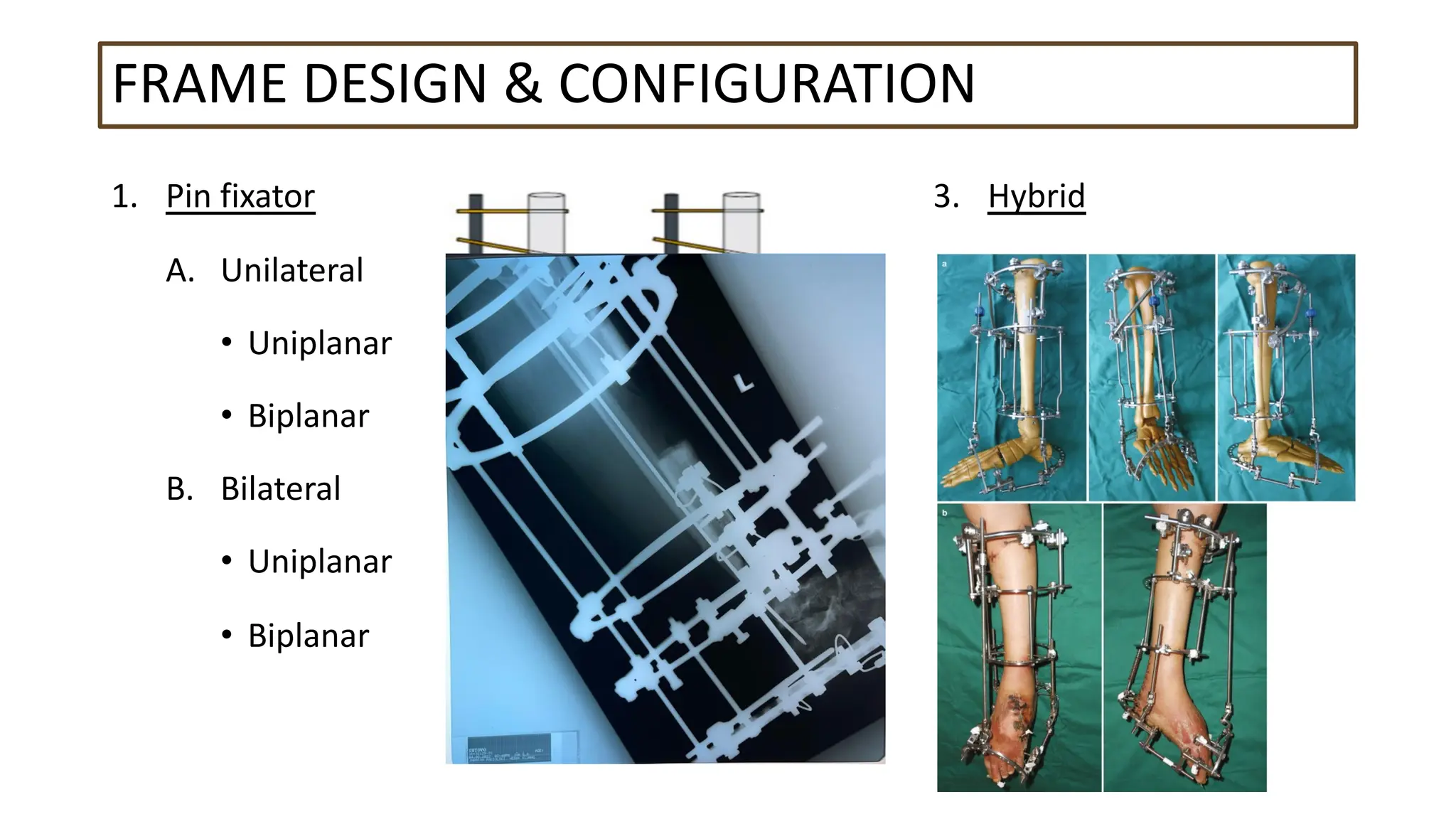 PRINCIPLE OF EXTERNAL FIXATION FOR OPEN FRACTURE.pdf