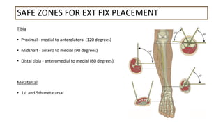 PRINCIPLE OF EXTERNAL FIXATION FOR OPEN FRACTURE.pdf