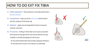 PRINCIPLE OF EXTERNAL FIXATION FOR OPEN FRACTURE.pdf