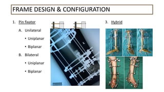 PRINCIPLE OF EXTERNAL FIXATION FOR OPEN FRACTURE.pdf
