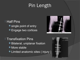 External fixation ali sarhan | PPT