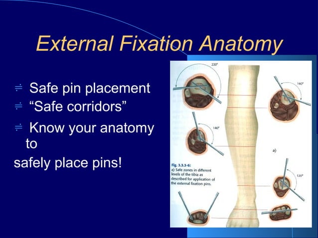 external fixation indications and techniques.pptx