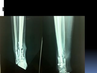 External fixation in open tibial fractures best evidence | PPTX
