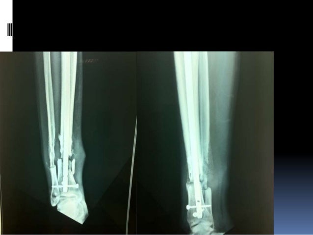 External fixation in open tibial fractures best evidence