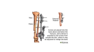 External fixation overview and princibles | PPTX