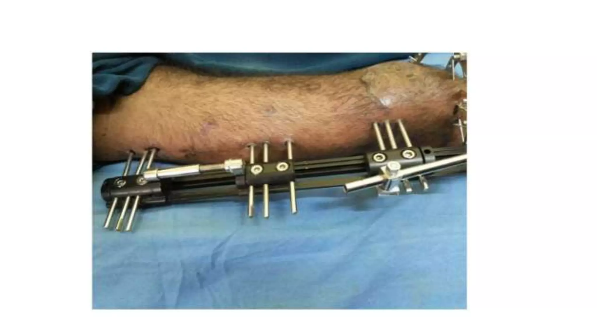 External fixation | PPTX