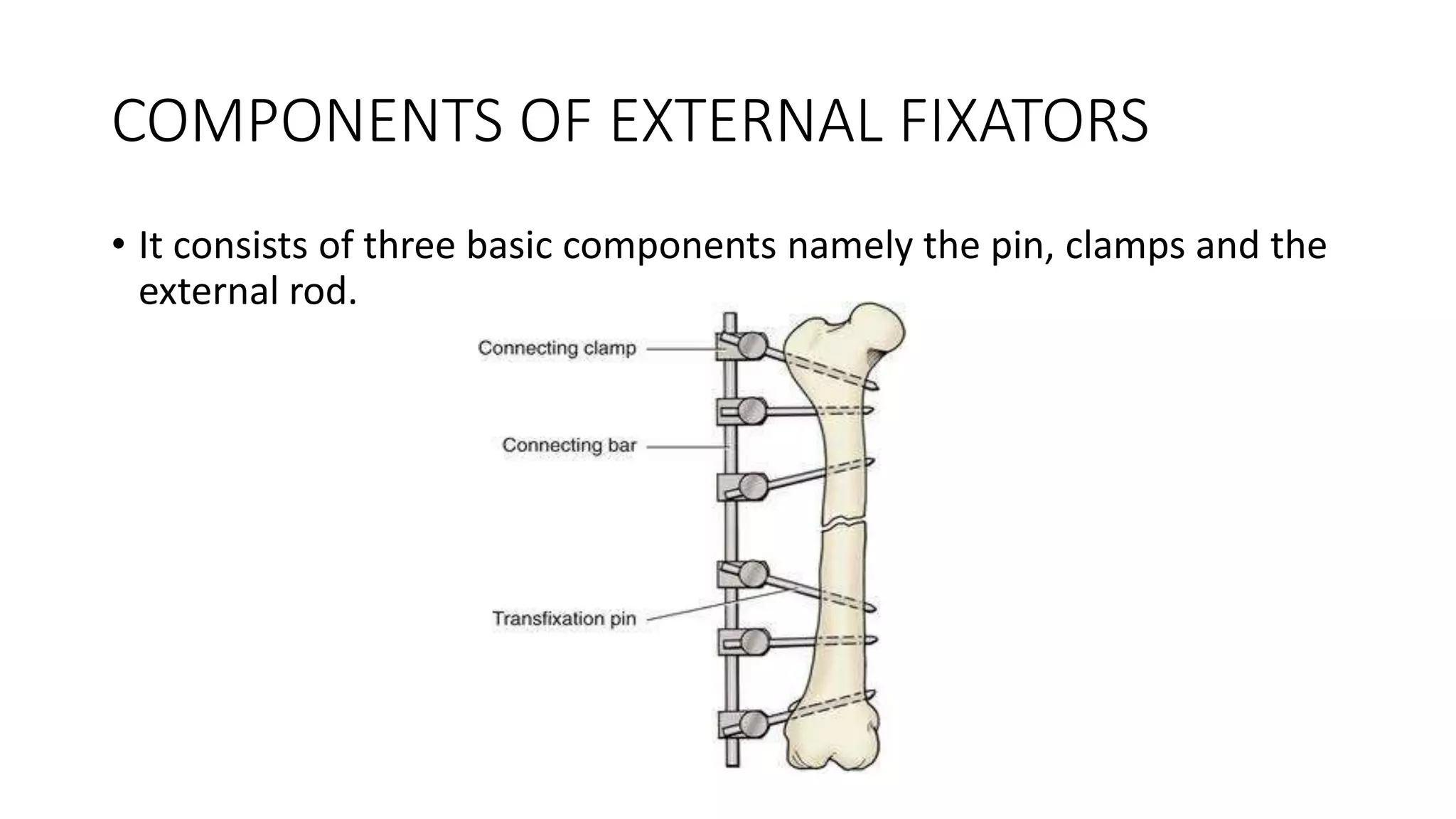 External fixation | PPTX