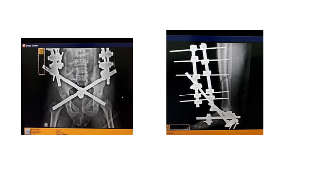External fixation | PPTX | First Aid | Injuries