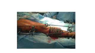 External fixation | PPTX