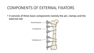 External fixation | PPTX