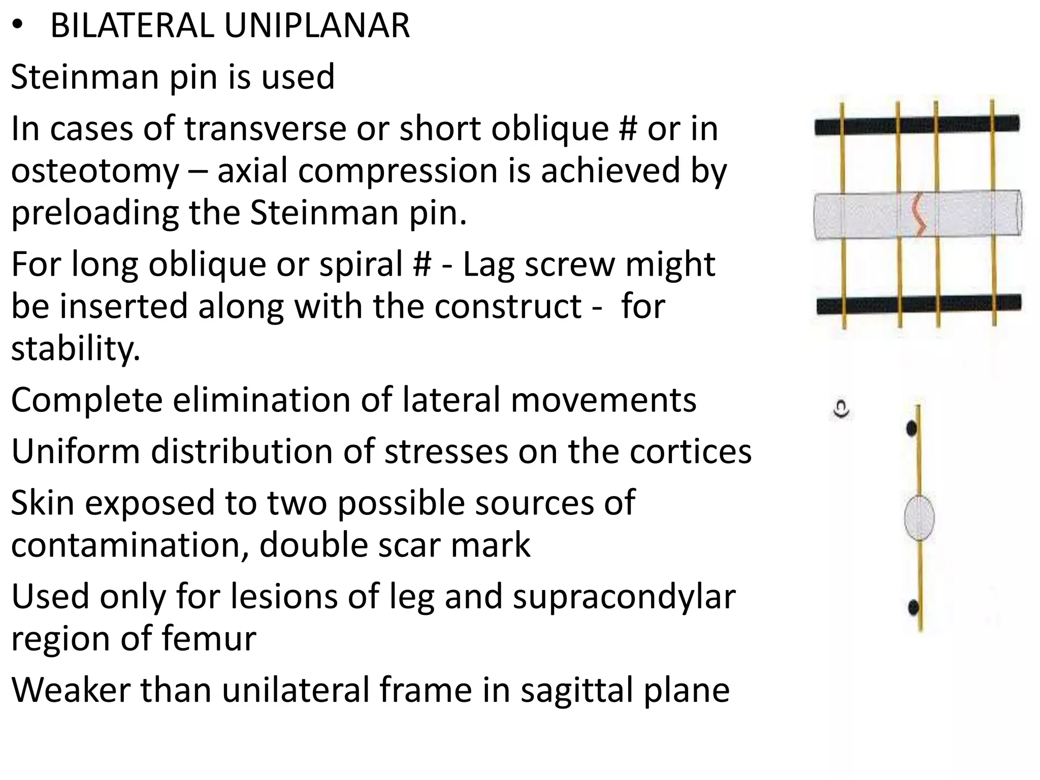 External fixator | PPTX
