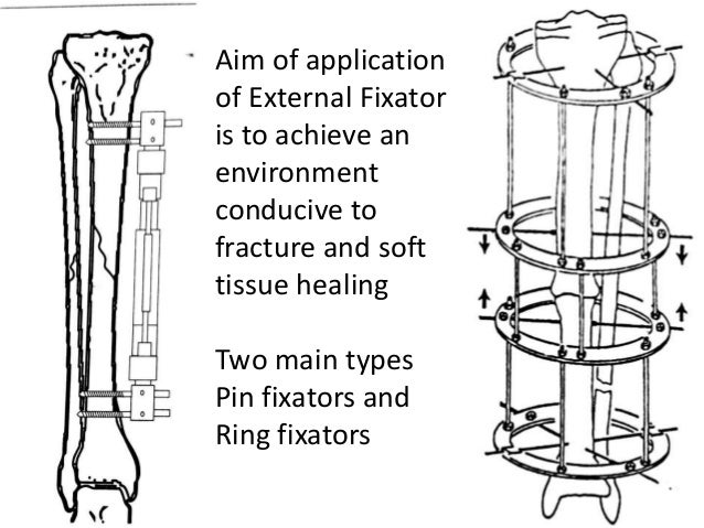 External fixator